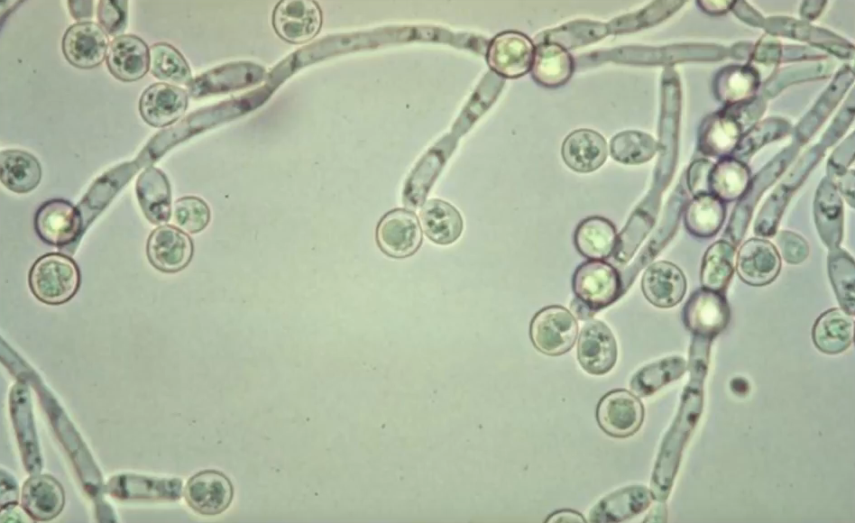 Can Alcohol Be The Cause Of Your Oral Thrush? YES!